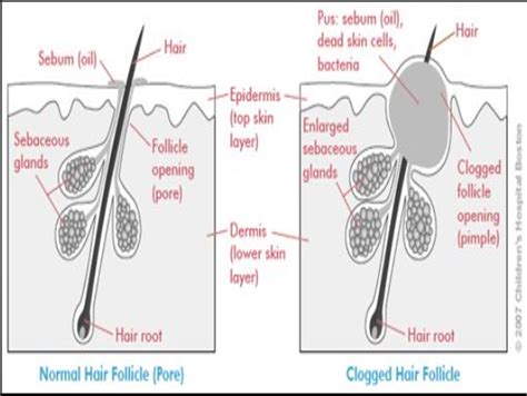Understanding And Dealing With Clogged Pores On Breasts