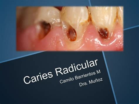 Caries Radicular Compl Ppt Free Download