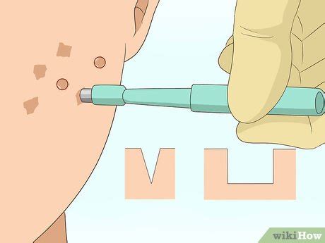 Ways To Get Rid Of Acne Scars Fast Wikihow