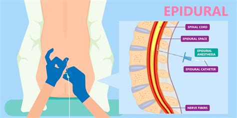 Espaco Epidural