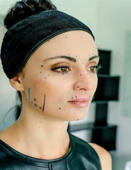 Botulinum Toxin Aesthetic Lab