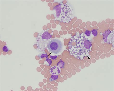 Peritoneal Fluid Eclinpath