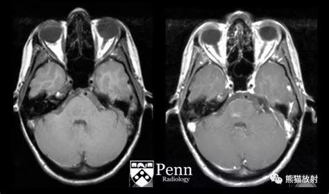 双语病例丨颅内毛细血管扩张症（mr）