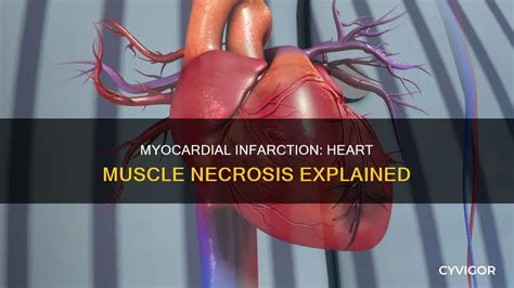 Myocardial Infarction Heart Muscle Necrosis Explained Cyvigor