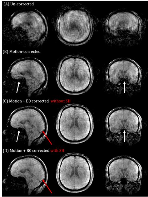Data Driven Motion Corrected Brain Mri Incorporating Pose Dependent B0 Fields