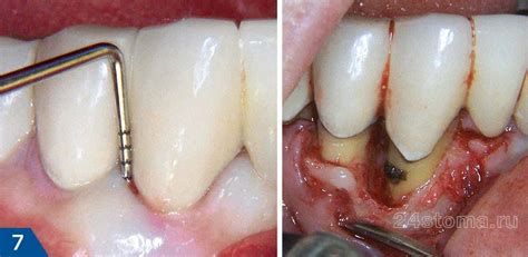 Зубной камень – фото, причины, удаление камней на зубах