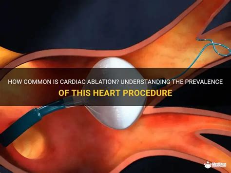 How Common Is Cardiac Ablation Understanding The Prevalence Of This Heart Procedure Medshun