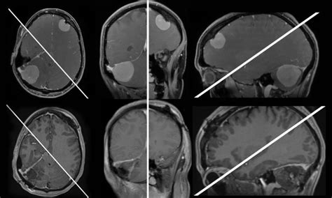 Nitesh Patel On Linkedin Two Tumors Two Cranis One Surgery Home