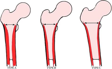 Ortho Pics The Dorr Classification Evaluates The Quality Facebook