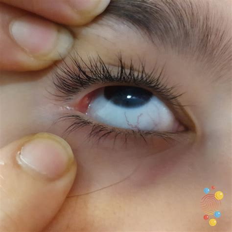 Chalazion Skin Deep