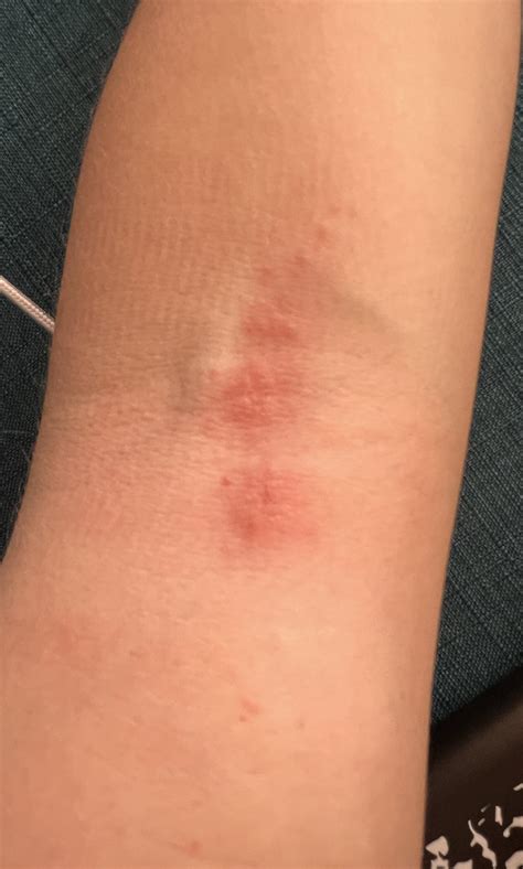 Rash Or Bug Bite Reaction R Dermatologyquestions