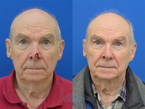 Mohs And Skin Cancer Surgery Before And After Pictures Case 4 Charlotte Nc Dilworth Facial