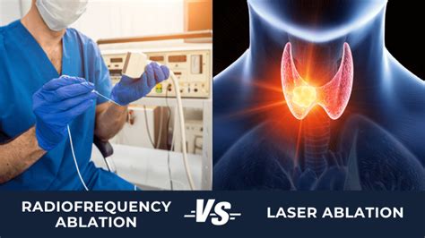 Radiofrequency Ablation Vs Laser Ablation Rfamd