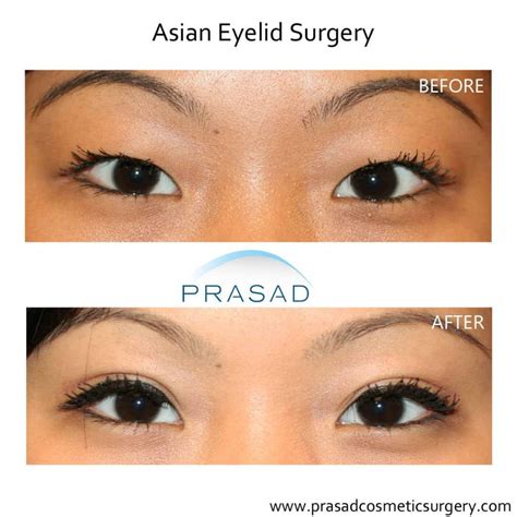 Korean Plastic Surgery Eyelid