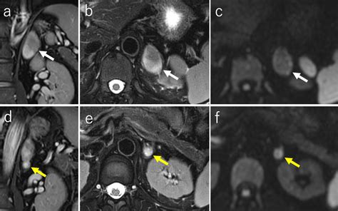 46 Year Old Man With Headache Hypertension And Elevated Plasma