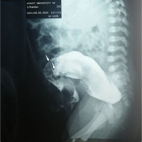 Shows A Low Descending Colostomy That Demonstrates Four Stomas POD3 Download Scientific