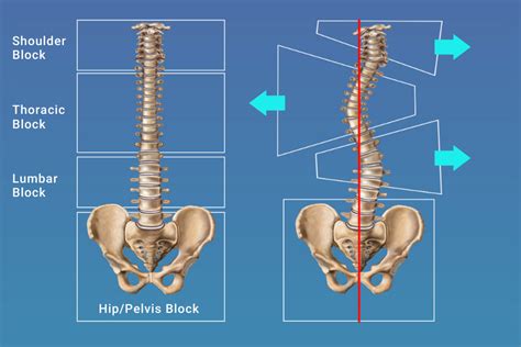 Scoliosis Exercises And Schroth Method Turanandturan