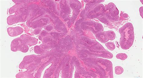 Hpv Associated Squamous Cell Carcinoma Of The Oropharynx Atlas Of Pathology