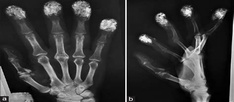 Calcinosis Circumscripta Journal Of Datta Meghe Institute Of Medical