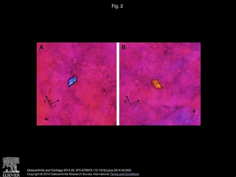 The Prevalence Of And Factors Related To Calcium Pyrophosphate Dihydrate Crystal Deposition In