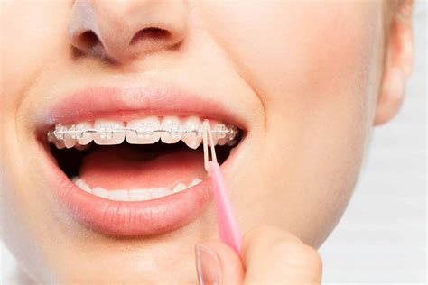 Rubber Bands In Your Mouth Why You Need To Wear Elastics For Braces