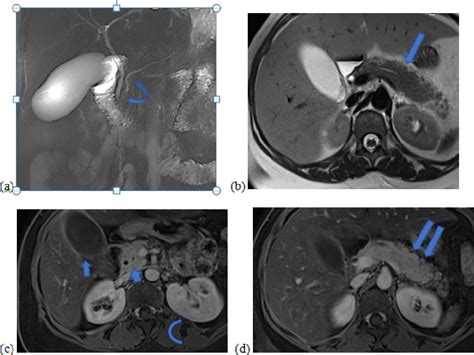 Figure 3 From Radiological Diagnosis Of Autoimmune Pancreatitis Aip