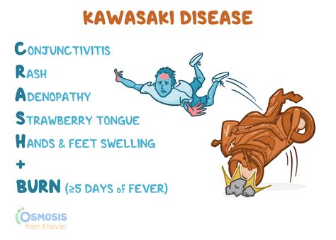 Kawasaki Disease Mnemonic Crash Burn At Kendall Mitchell Blog