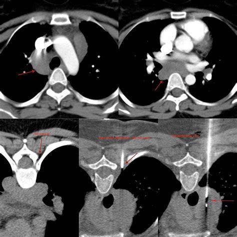 Trans Pulmonary Node Biopsy When Hydro Dissection Salinoma Does Not