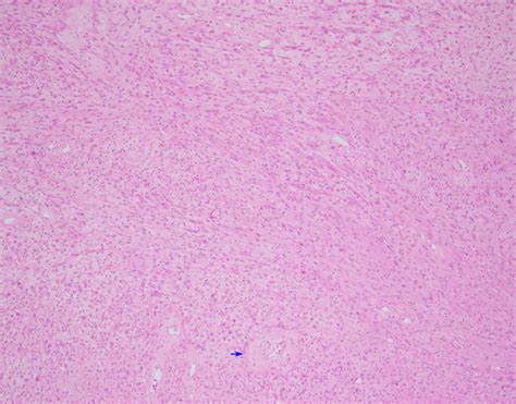 Fascicles Of Spindle Cells In A Background Of Fibrous Tissue