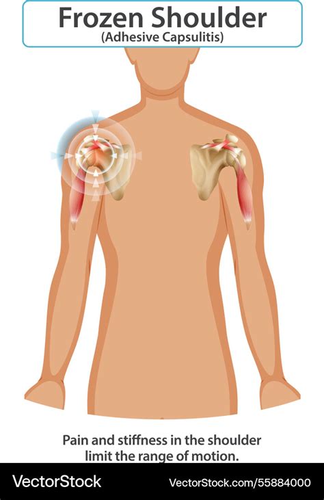 Shoulder Anatomy And Adhesive Capsulitis Vector Image