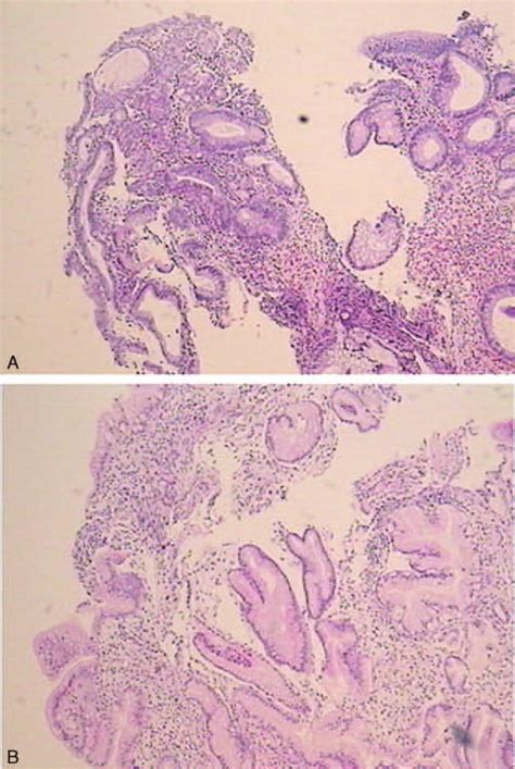 A Biopsies From Polyps In The Antrum Showing Chronic Inflammation In Download Scientific