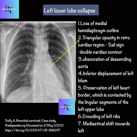 Radiologist Lung Collapse On Chest X Ray Radiology Xray