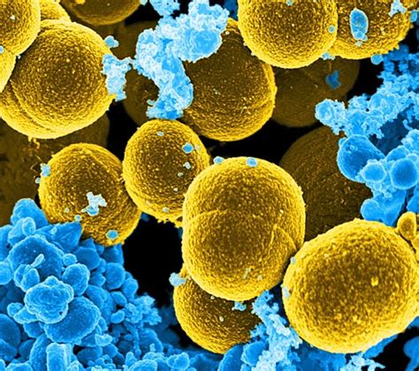 Staphylococcus Aureus In Patients Diagnosed With Bronchiectasis Without Cystic Fibrosis
