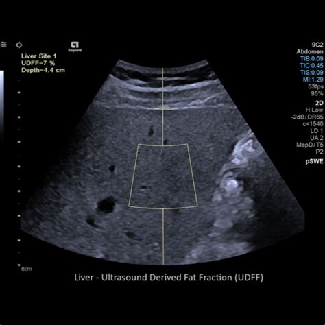 Ultrasound Derived Fat Fraction Udff White Paper Liver Ultrasound