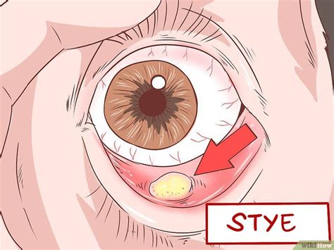How To Identify Symptoms Of Mrsa 13 Steps With Pictures Artofit