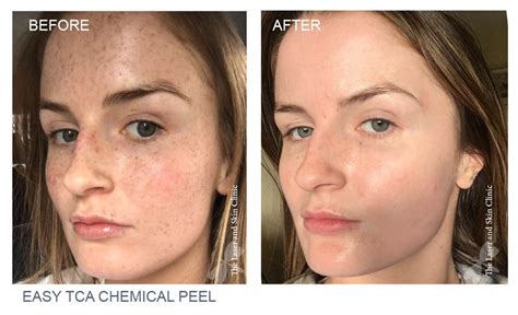 TCA BEFORE AFTER Right Side Goss Ie