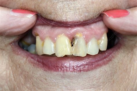 Tooth Decay Chemotherapy And Radiation Oral Care
