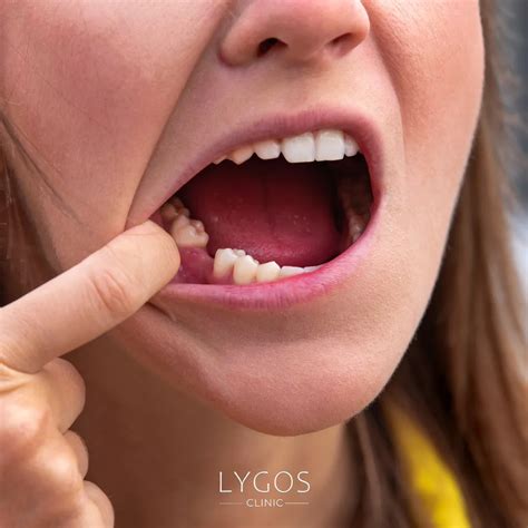 Teeth Shifting Teeth Shifting After Braces Lyg 2025