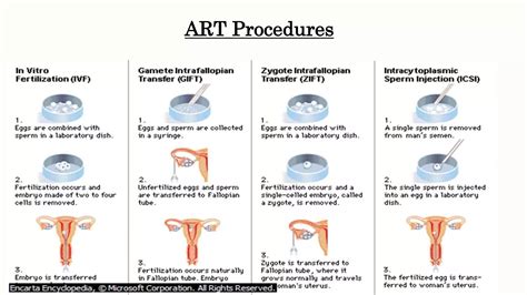 Assisted Reproductive Technology Pptx