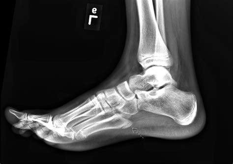Overuse Injuries In Pediatric Athletes Advances In Pediatrics