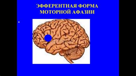 Инсульт Восстановление речи Эфферентная моторная афазия Упражнения Youtube