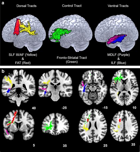 representative examples of successful streamlines of white matter