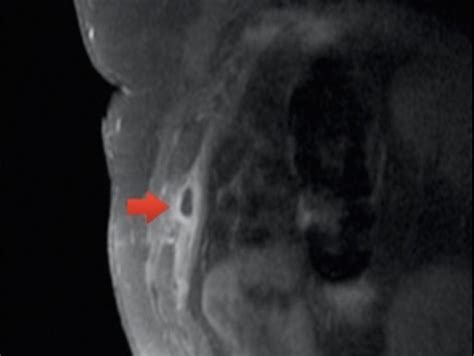 Epipericardial Fat Necrosis An Important Differential Diagnosis Of