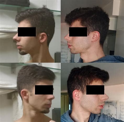 Mewing And Chewing From 25 To 26 Yo R Mewing