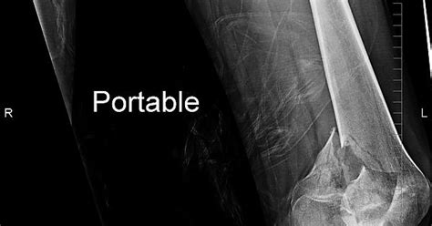 Bones And Titanium Album On Imgur