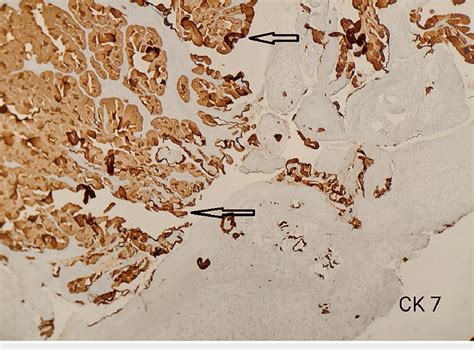 Ihc Staining Showing Positive Immunohistochemical Stain For Ck 7 Ihc
