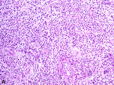 Breast Biopsy A Diffuse Blasts Infiltration B More Mature Download Scientific Diagram