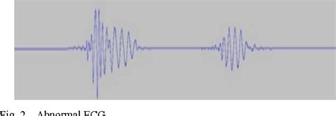 Figure 2 From Ecg Signals Classification Using Mfcc Coefficients And Ann Classifier Semantic