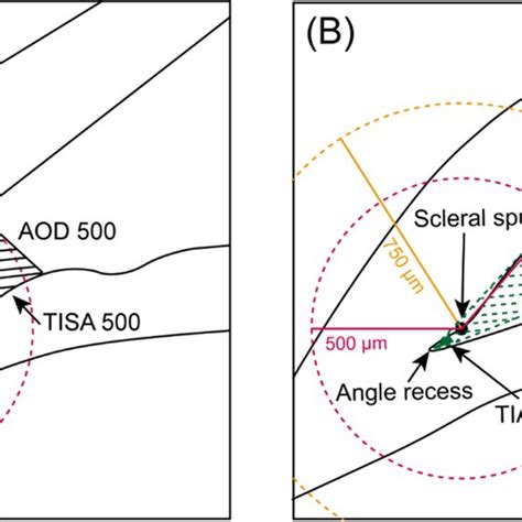 Quantitative Determination Of The Anterior Chamber Angle Parameters Download Scientific Diagram