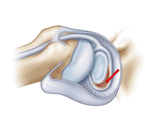 Shoulder Dislocation Treatment In Dahisar Dr Anand Walavalkar